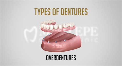 Overdentures A Complete Guide Maltepe Dental Clinic