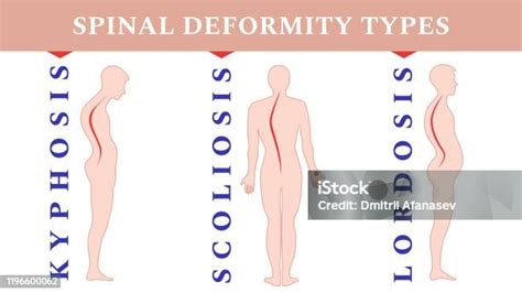 척추질환 척추측만증 로데증 척추지만증 신체 자세 결함 뒤로 곡률 척추 기형 유형 의료 질병 인포 그래픽 진단 증상 벡터 그림입니다 건강 진단에 대한 스톡 벡터 아트 및 기타