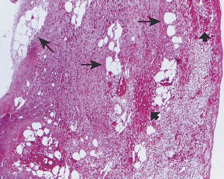 Emphysematous Cholecystitis Pathology Outlines