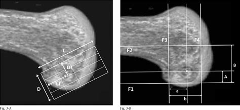 Figure 3 From Anatomic Single Bundle Acl Reconstruction Is Possible