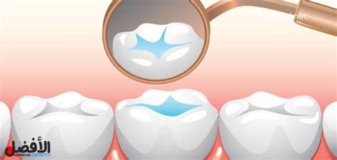 تسوس الأسنان؛ 3 أنواع رئيسية لهذه المشكلة التي تصيب الكثيرين