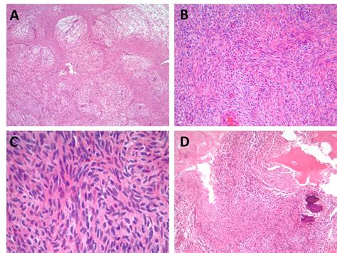 Spindle Cell Neoplasm With Atypia At Isabella Jolly Blog