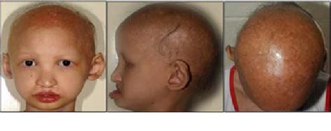 Figure 3 From Ankyloblepharon Ectodermal Defects Cleft Lip Palate Aec Syndrome In Monozygotic