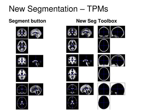 Ppt Voxel Based Morphometry With Unified Segmentation Powerpoint
