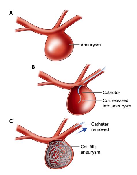 Brain Aneurysm Repair Surgery
