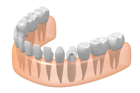Dental Steel Post Installation Incisor Tooth Dental Endodontic