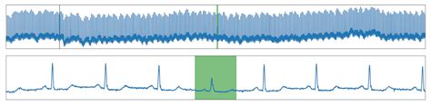 Is It Worth It Comparing Six Deep And Classical Methods For Unsupervised Anomaly Detection In