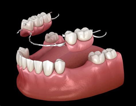 Partial Dentures For Upper Back Teeth Restore Your Smile Hummingbird Dental Voted Top