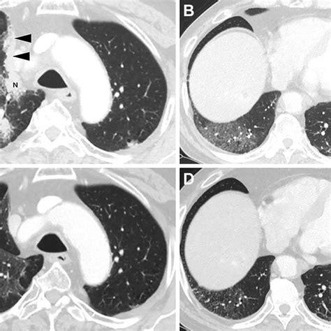 Chest X Ray Revealed Bilateral Interstitial Micronodular Pattern Download Scientific Diagram