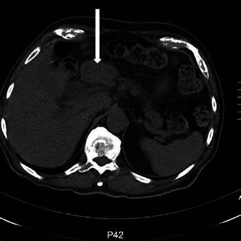 Palliative Cholecystojejunostomy Bypass Procedure Download