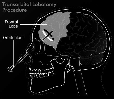 Transorbital Lobotomy Kennedy
