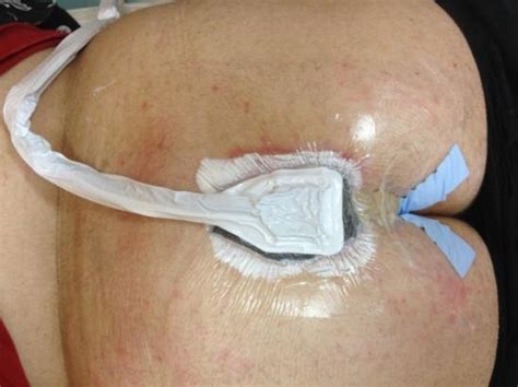 Pilonidal Abscess Drainage