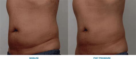 Hifu Body Tightening London Premier Laser Clinic