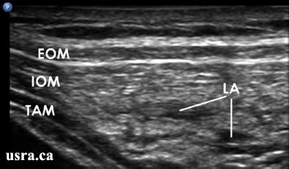 Usra Ilioinguinal Iliohyprogastric Nerve Block
