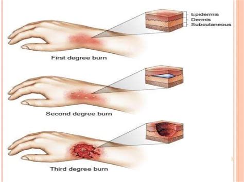 Burns All You Needed To Know Types Of Burns Precautions First Aid Emergency DESUN