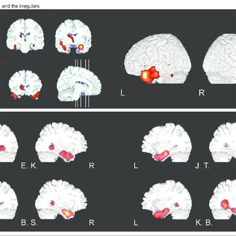 A Result Of A Conjunction Analysis Showing Regions Of Significant Download Scientific Diagram