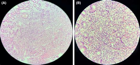 Illustrative Gastric Biopsy In Eosinophilic Gastritis A Low‐power