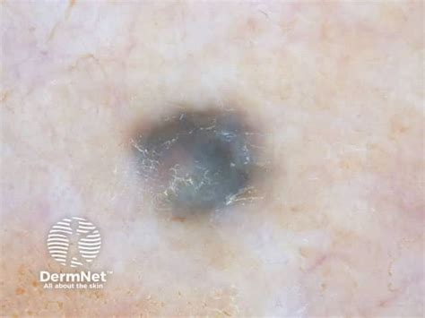 Dermoscopy Benign Melanocytic Lesions