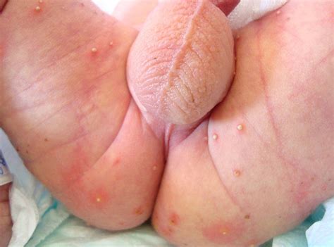 Transient Neonatal Pustular Melanosis Actas Dermo Sifiliográficas