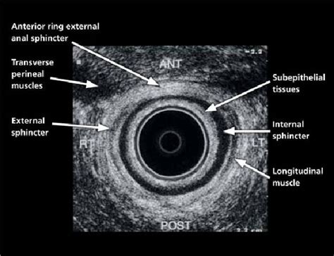 Obstetric Anal Sphincter Injuries Oasis