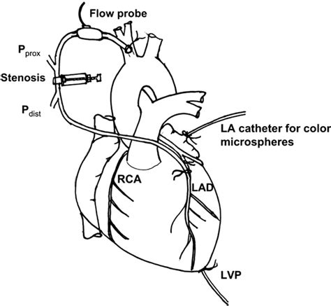 Figure 1 From Multilayer Radial Systolic Strain Can Identify