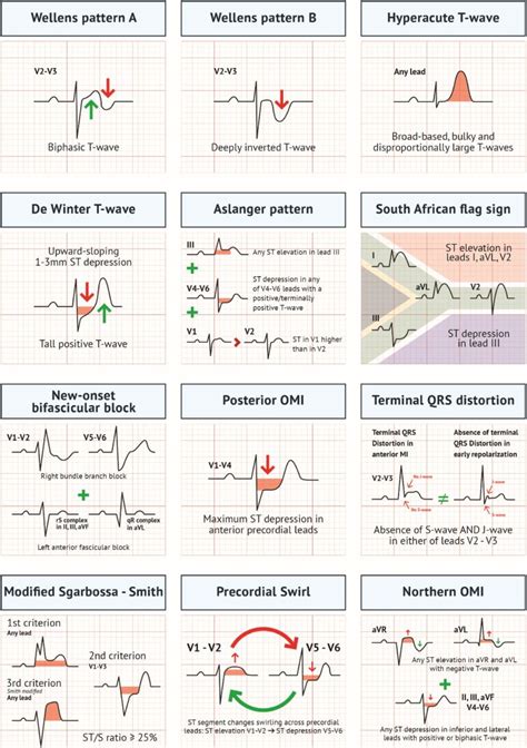 Ecg Patterns Of Occlusion Myocardial Infarction A Narrative Review Ccr Journal Watch