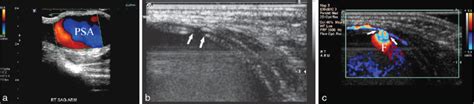 A Longitudinal View Of The Pulsatile Mass On Colour Doppler