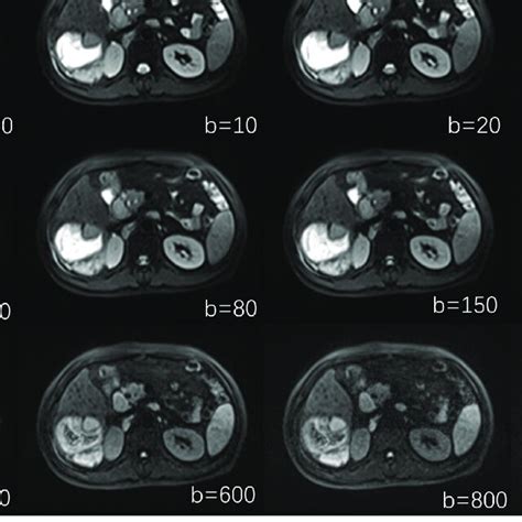 ivim images at different b values ivim dwi images with 12 b values