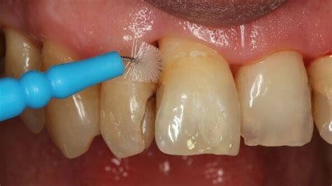 Gum Disease Prevention European Federation Of Periodontology