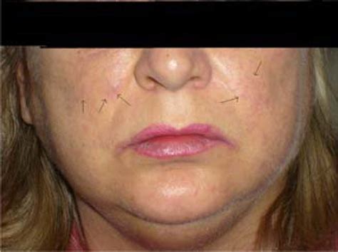 Liver Disease Symptoms Lipstick Liver Disease Symptoms Lipstick
