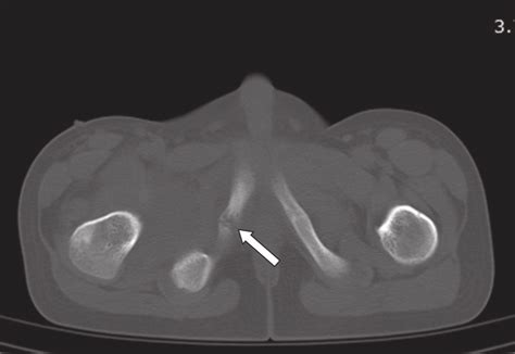 Computed Tomography Scan Right Ischiopubic Synchondrosis Enlargement Is Download Scientific