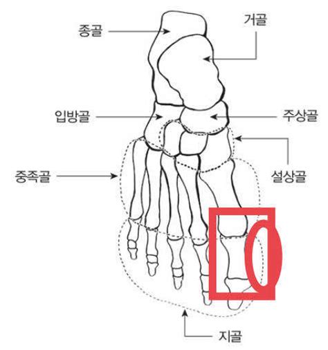 블라인드 블라블라 횽냐들 특이한 발모양인데 신기 편한 신발 추천부탁해 엄지발가락쪽 뼈 지골 사진에 표시한 부분이 많이 튀어나왔고 발볼 넓은 종류의 신발이 필요해