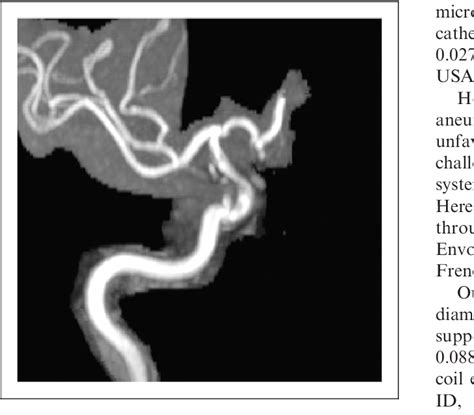 Figure 3 From Pipeline Embolization Device Deployment Via An Envoy Distal Access Xb Guiding