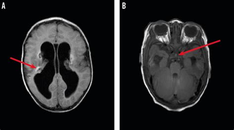 Congenital Toxoplasmosis Consultant360