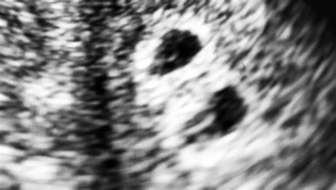 Embarazo Gemelar De 5 Semanas De Gestación Los Sacos Gestacionales