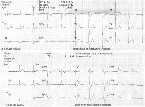 True Posterior Myocardial Infarction The Importance Of Leads V7v9