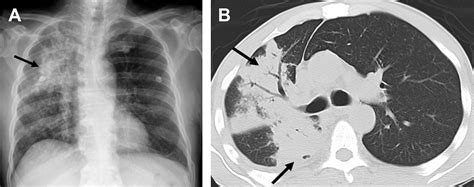 What Is Apico Lordotic Means Chest X Ray Ap Lordotic Projection Lindblom Method Radtechonduty