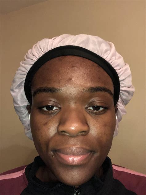 Can Accutane Impact Your Menstrual Cycle R Accutane