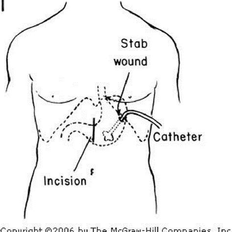 Stamm Gastrostomy