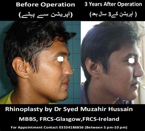 Removal Of Frontal Pyocele Dr Syed Muzahir