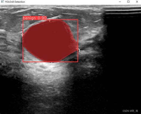 基于深度学习的乳腺癌智能检测分割与诊断系统【python源码pyqt5界面数据集训练代码】深度学习实战、目标分割、人工智能癌症识别系统