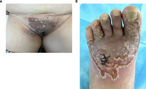 Frontiers Case Report A Rollercoaster Journey Of Pemphigus Vegetans