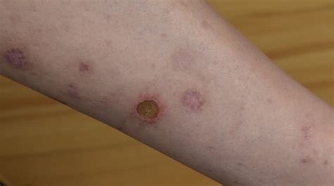 Sarcoid Osis School Of Medicine