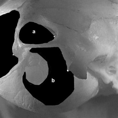 Suprameatal Triangle