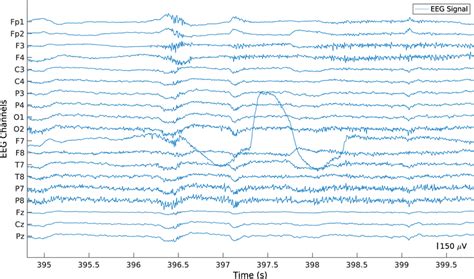Eeg Electrode Pop Artifact At James Fontanez Blog