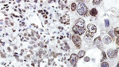 Mayo Clinic Uncovers Hidden Driver Fueling Aggressive Prostate Cancer