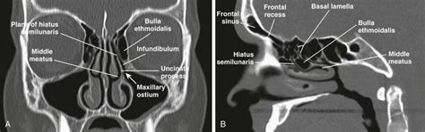 Uncinate Process Of Ethmoid