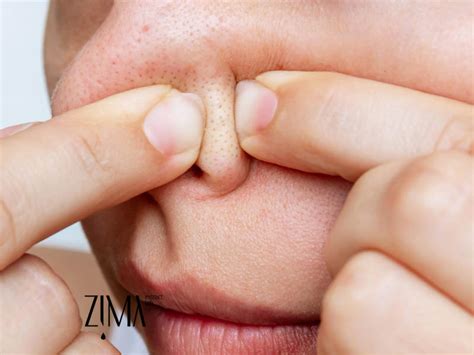 انواع و علت جوش روی بینی و راه های درمان آن زیمالب