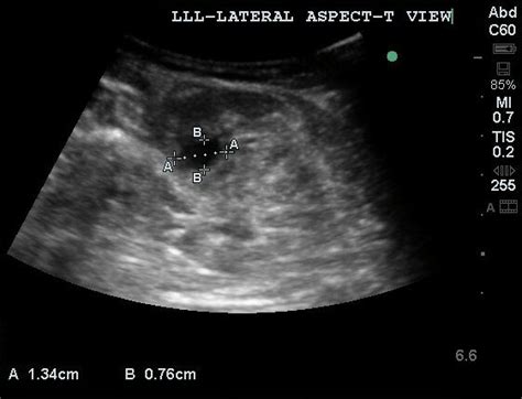 1 6x1 1cm Non Compressible Non Pulsatile Hypoechoic Area With Download Scientific Diagram