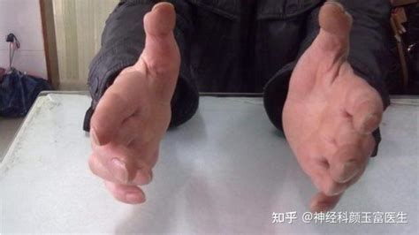 神经损伤（受损）还能恢复吗？多久能恢复？神经损伤恢复并不难！ 知乎